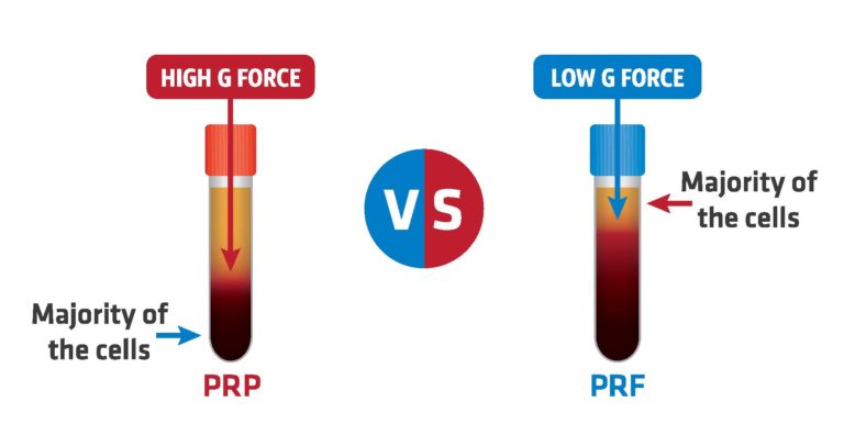 Platelet-Rich Fibrin - Aesthetic Technique by AIAM Trainings